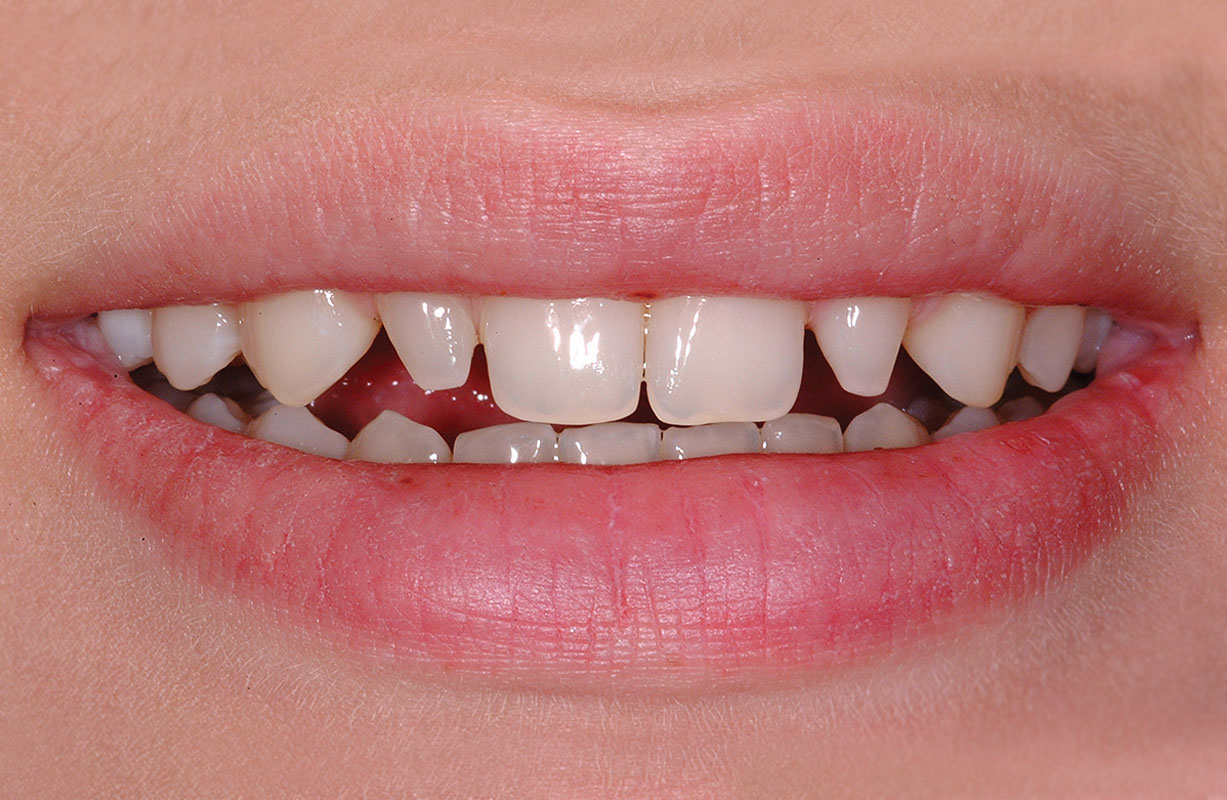 Space closure and undersized teeth – Bioclear Clinic