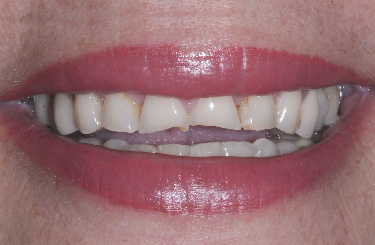 Worn Teeth Restoration – Bioclear Clinic