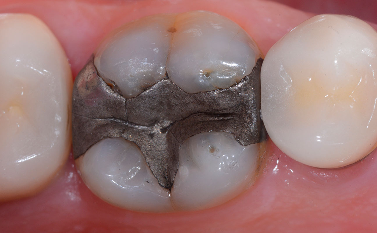 Bioclear Posterior Restorations – Bioclear Clinic